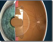 STAAR Surgical Releases New Intraocular Lenses – Alternative to Lasik ...